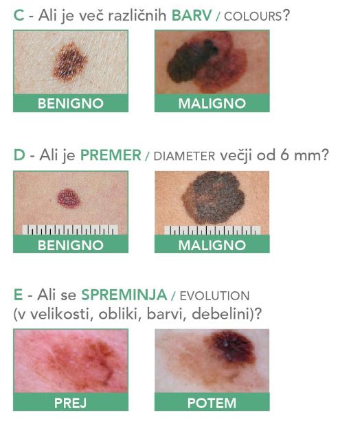 Kožni rak lahko doleti vsakogar, še posebej tiste, ki so bili opečeni v ...