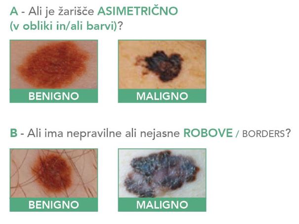 Kožni rak lahko doleti vsakogar, še posebej tiste, ki so bili opečeni v ...