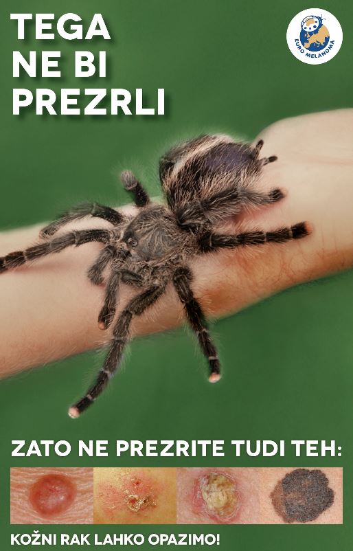 Kožni rak lahko doleti vsakogar, še posebej tiste, ki so bili opečeni v ...