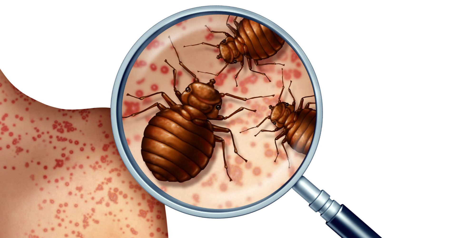 Kako se znebiti stenic, kako zatirati posteljne stenice? Ugriz stenice ...